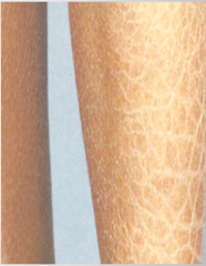 Dermatology - TopicaL Therapy and Topical Corticosteroids - Flashcards ...