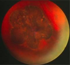 Congenital Anomalies of the Retina | StudyHippo.com