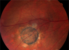 Congenital Anomalies of the Retina | StudyHippo.com