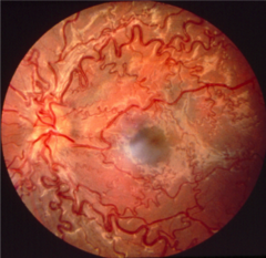 Congenital Anomalies of the Retina | StudyHippo.com