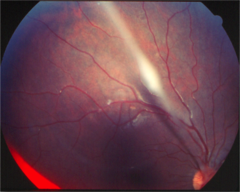 Congenital Anomalies of the Retina | StudyHippo.com