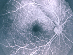 Congenital Anomalies of the Retina | StudyHippo.com