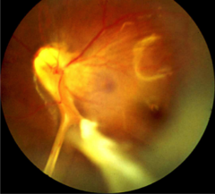 Congenital Anomalies of the Retina | StudyHippo.com