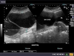 Pathology of the ovaries 2 - Flashcards | StudyHippo.com